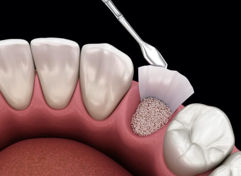 Understanding Bone Augmentation: What It Is and Why You Might Need It ...